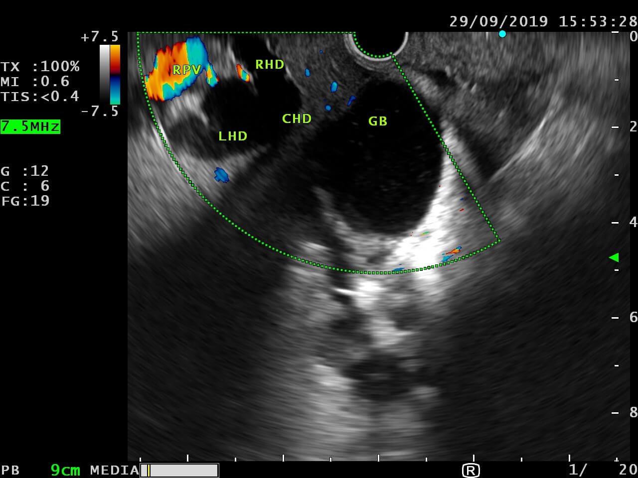 Endoscopic Ultrasonography Best Gastroenterology In Delhi Ncr