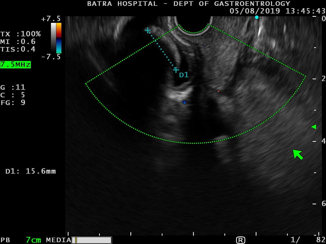 Endoscopic Ultrasonography - Best Gastroenterology In Delhi NCR
