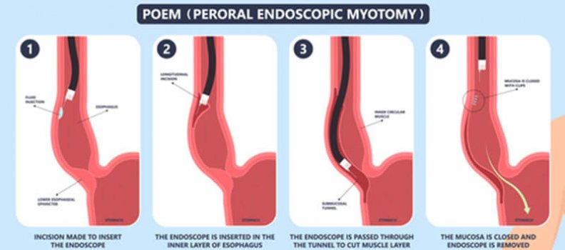 Per Oral Endoscopic Myotomy Archives - Best Gastroenterology In Delhi NCR